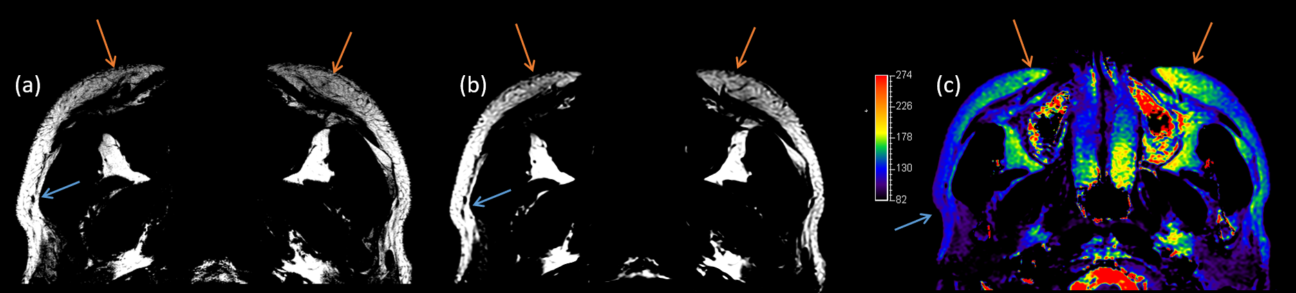 MRI Application for Autologous Fat Transplantation Assessment