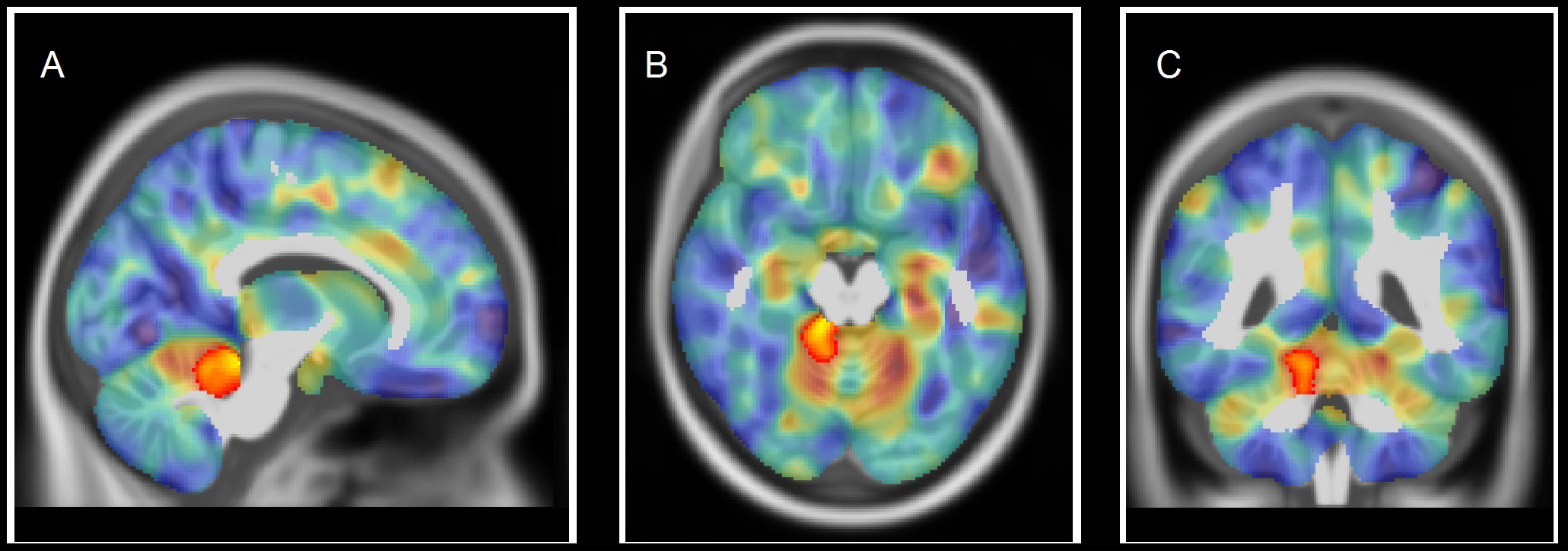 Unthresholded effect size(Cohen’s d) map (in blue-red) and thresholded ...