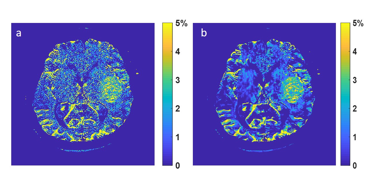 Figure5. MTR asym at 3.5 ppm using standard recon (a) and DL recon (b).