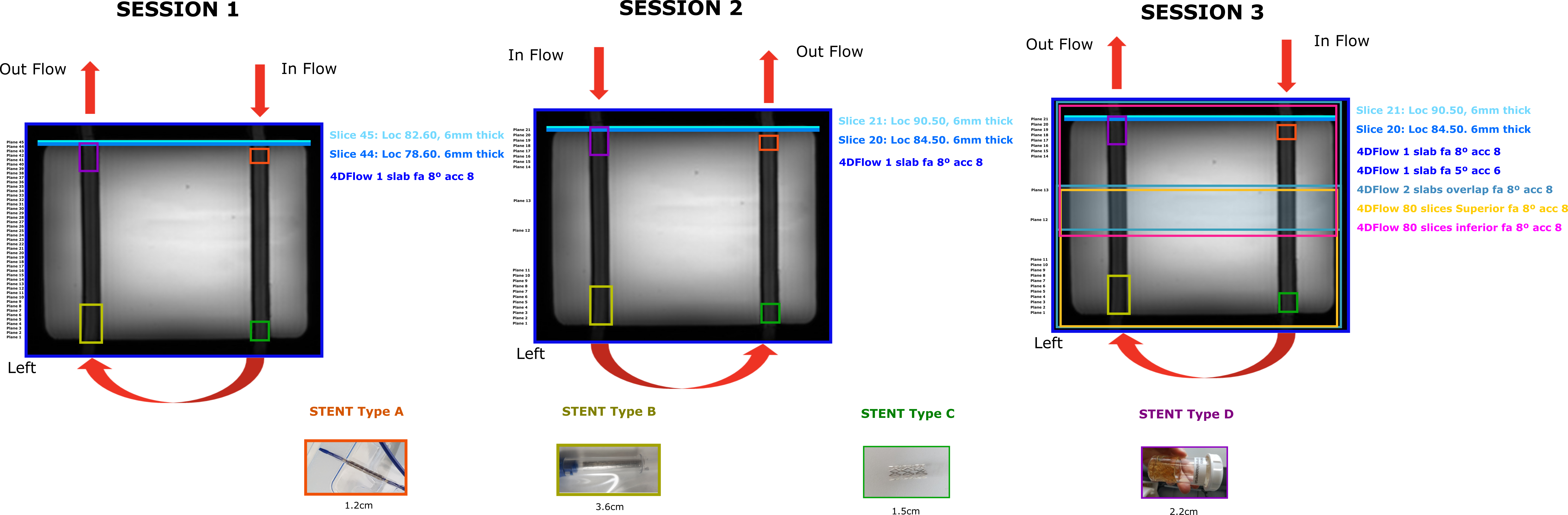 Accurate in-stentnet flow measurements were only possible for platinum-iridium. There ...