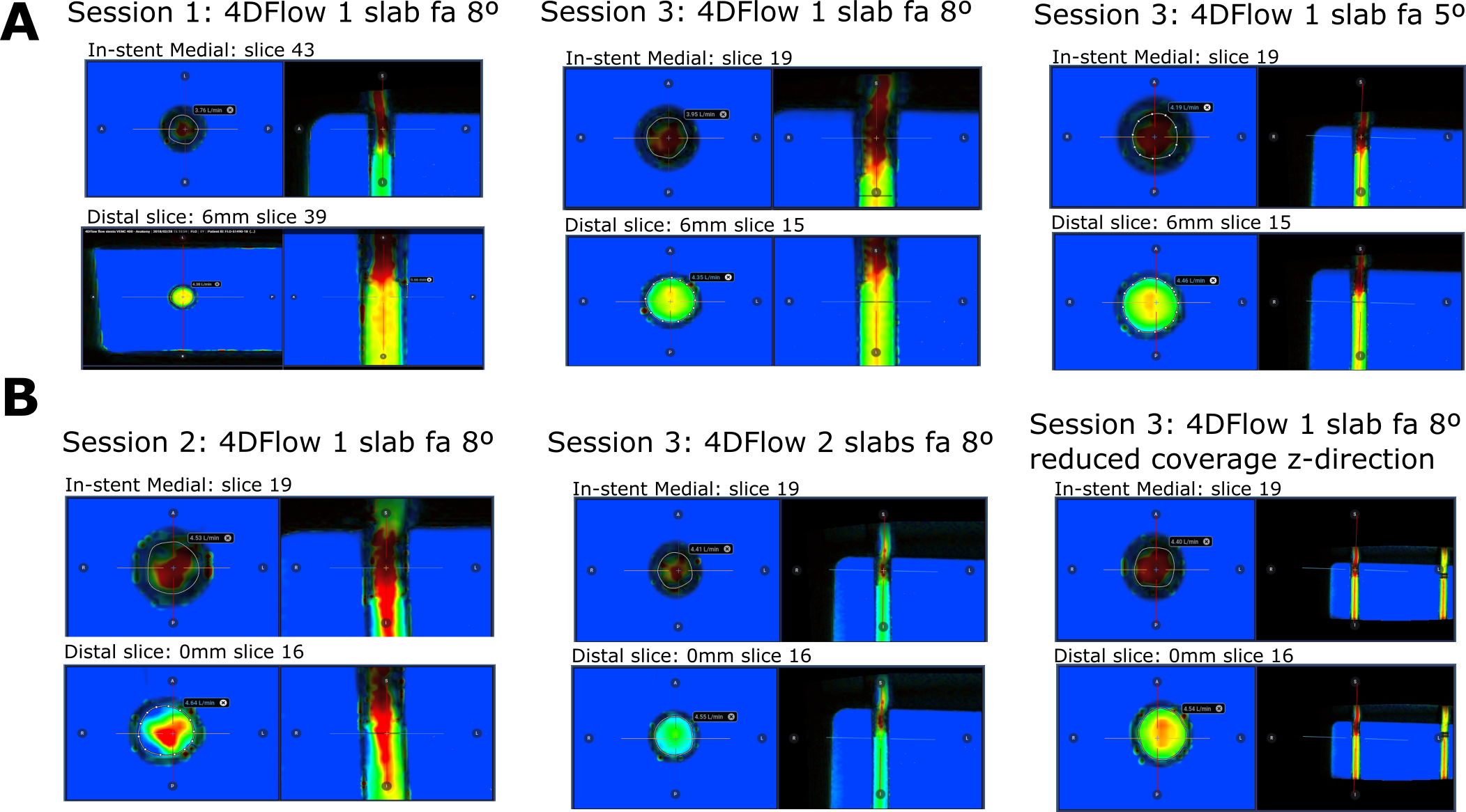 Figure 4: 4DFlow zoom images from type D stent across session 1 -2 -3 of selected ROIs. Medial ...