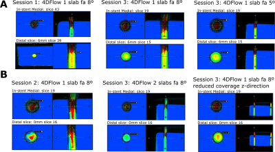 Figure 4: 4DFlow zoom images from type D stent across session 1 -2 -3 ...