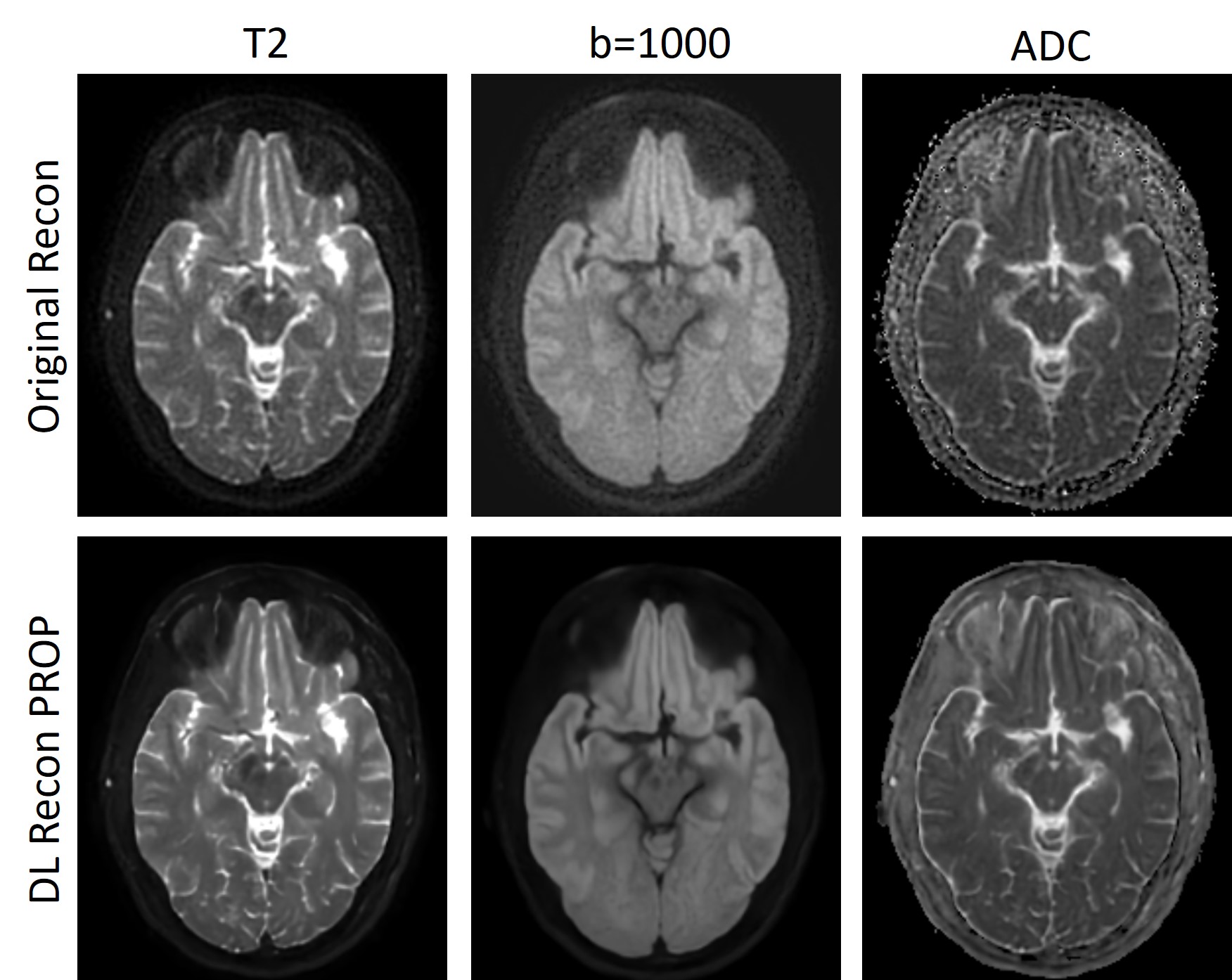 Diffusion Weighted Imaging using PROPELLER Acquisition and a Deep ...