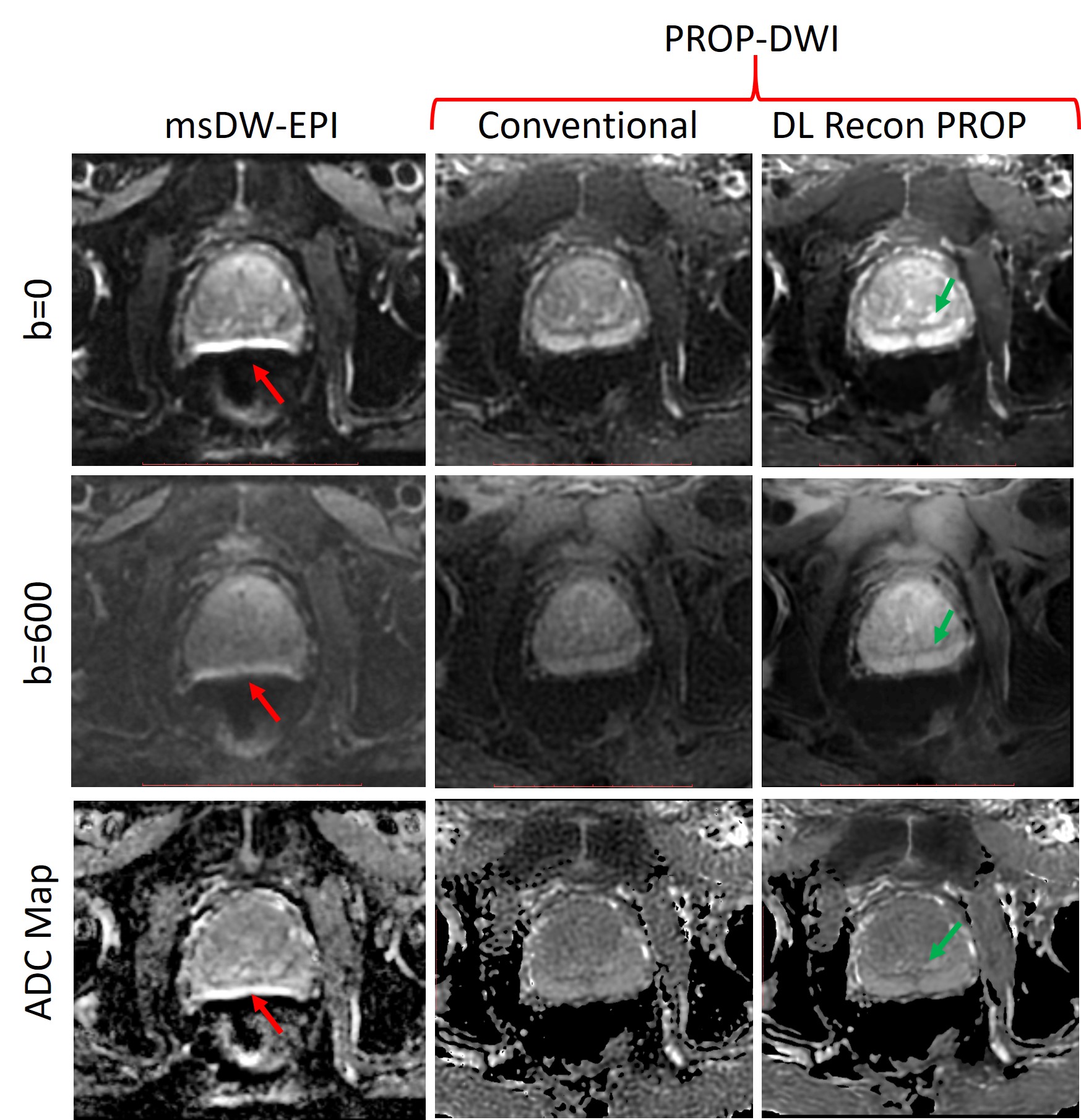 Diffusion Weighted Imaging using PROPELLER Acquisition and a Deep ...
