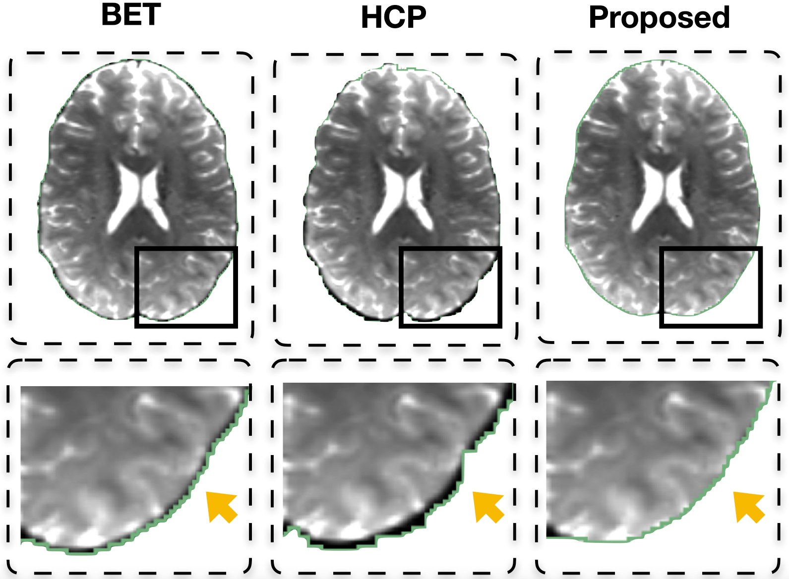 Figure 1. Extraction of the adult brain using BET, the HCP pipeline and the proposed method.
