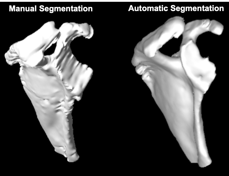 Figure 2: 3D-MRI based scapular bone reconstruction using: (left ...