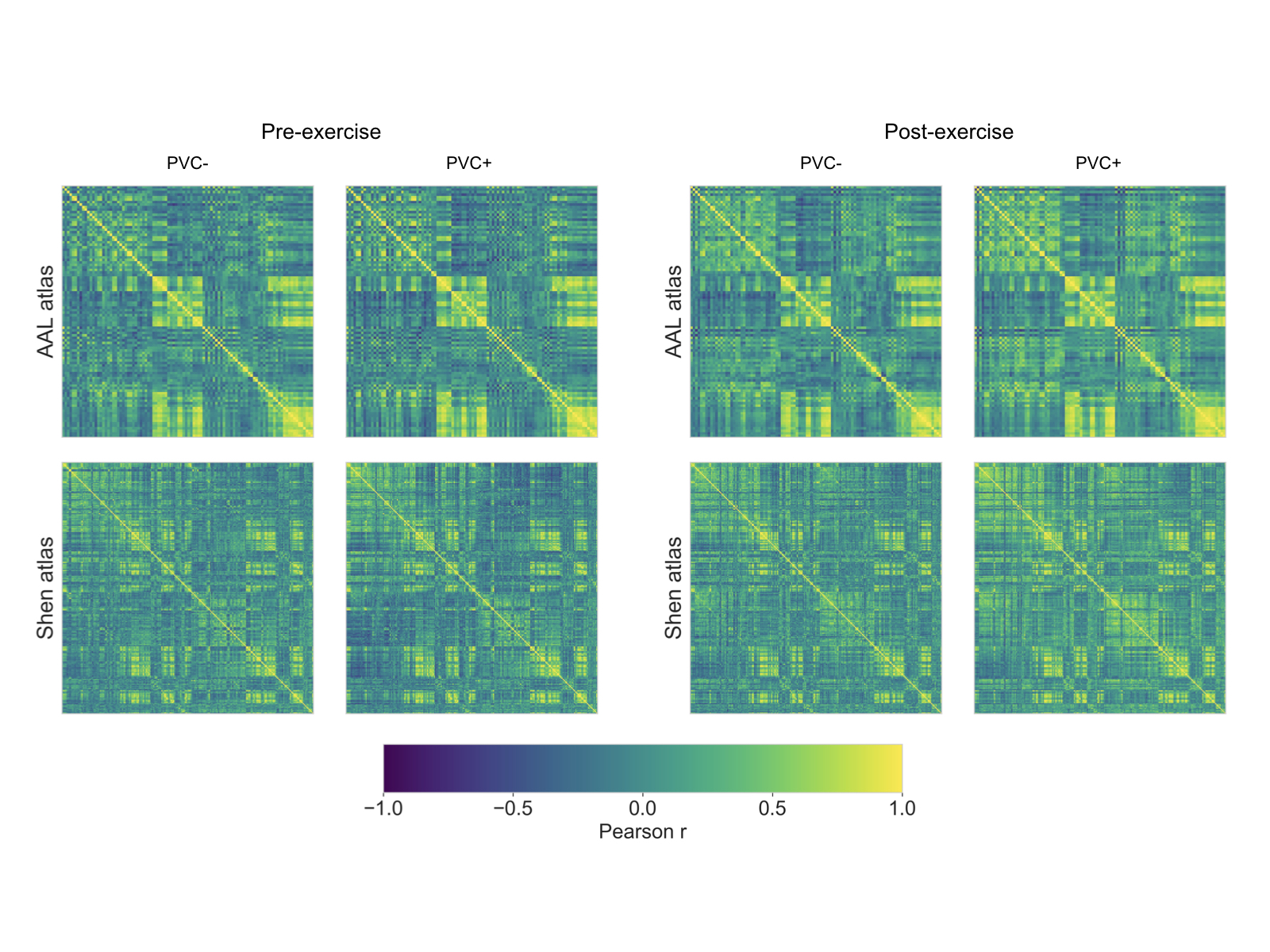 Figure 1. CBF covariance maps at pre- ( left ) and post- ( right ...