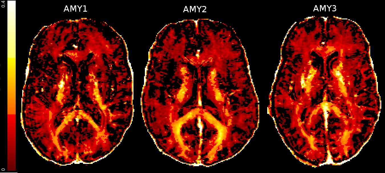 Myelin water imaging of Amyoplasia: Comparison to a control atlas